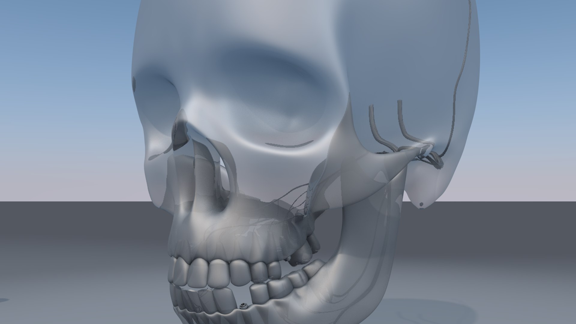 Skull Jaw Dental Implant 3D Model - TurboSquid 1326588