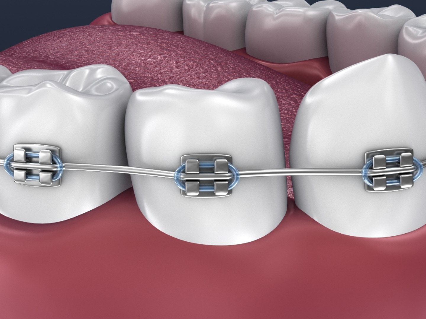 Dental Orthodontic Braces 3D Model - TurboSquid 1340515