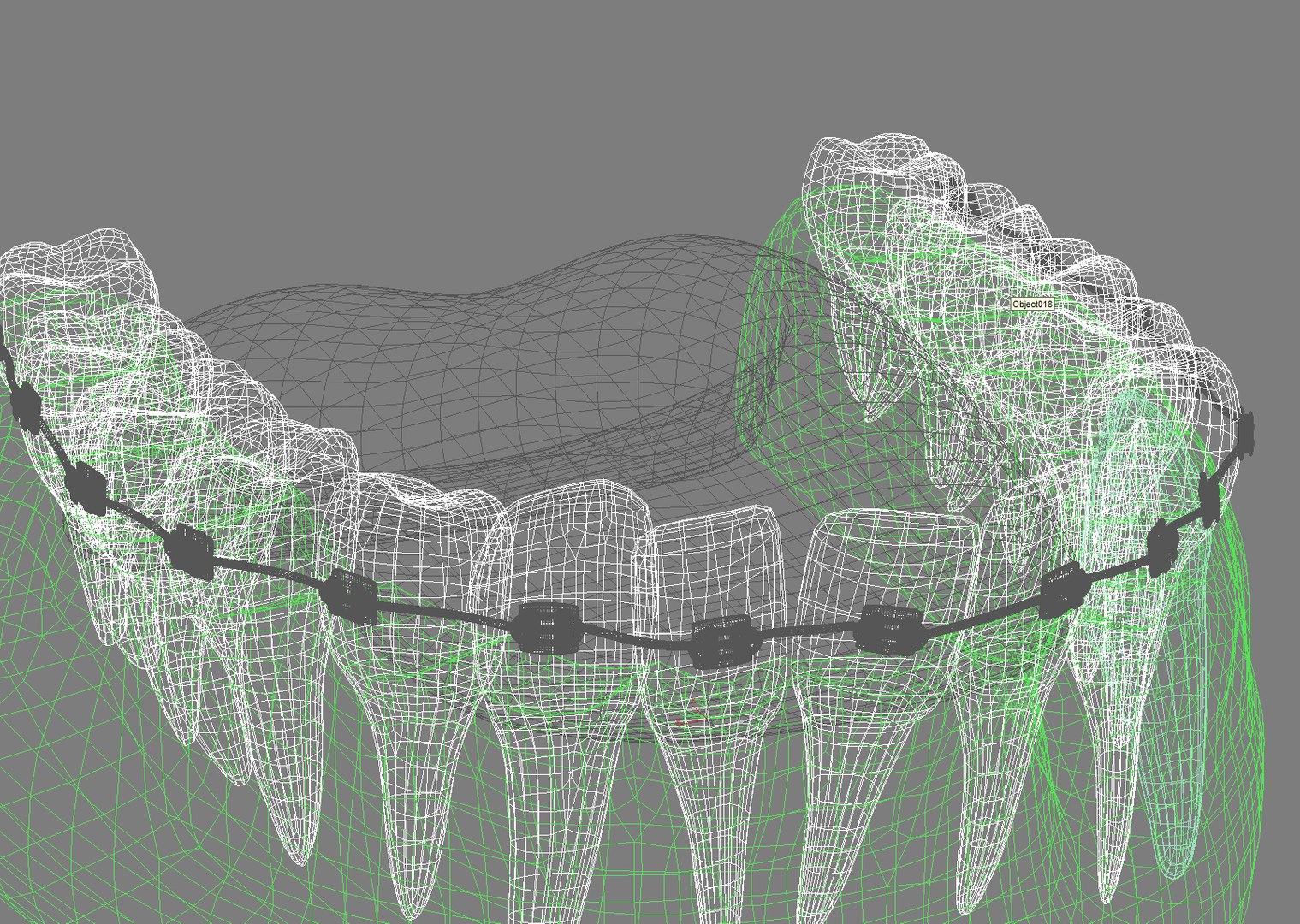 Dental Orthodontic Braces 3D Model - TurboSquid 1340515