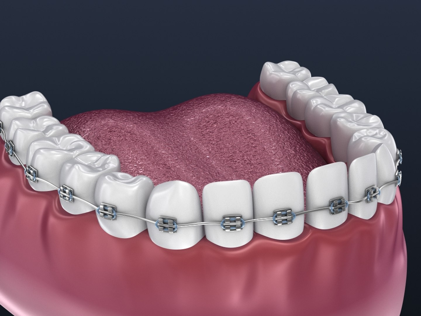 Dental Orthodontic Braces 3D Model - TurboSquid 1340515