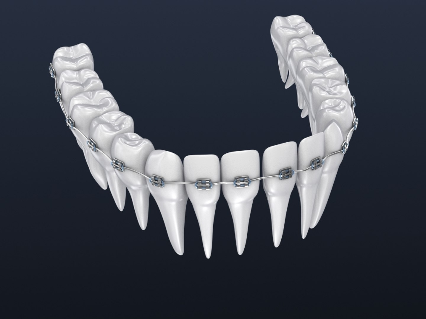 Dental Orthodontic Braces 3D Model - TurboSquid 1340515