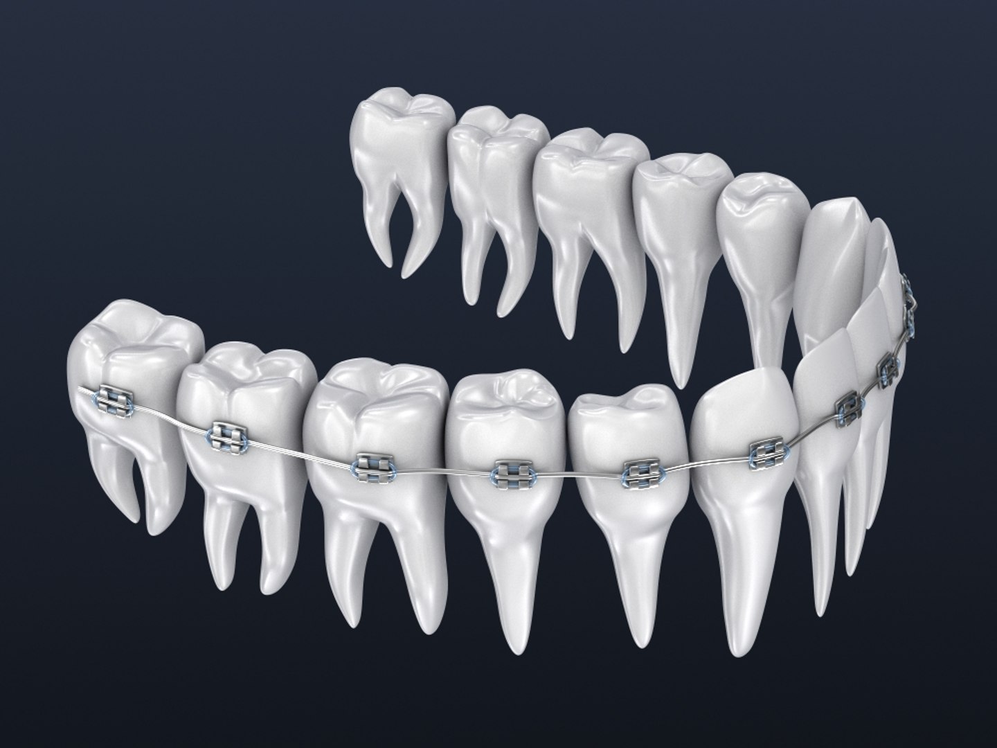 Dental Orthodontic Braces 3D Model - TurboSquid 1340515