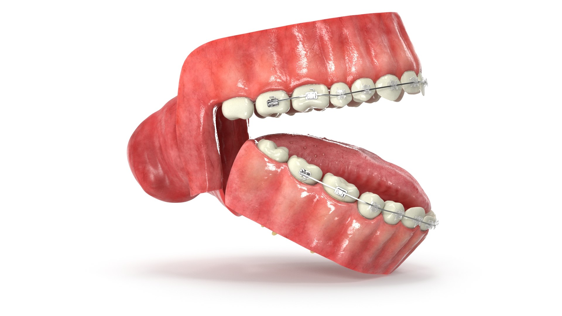 Human Mouth With Self Ligating Transparent Dental Braces V03 Model ...