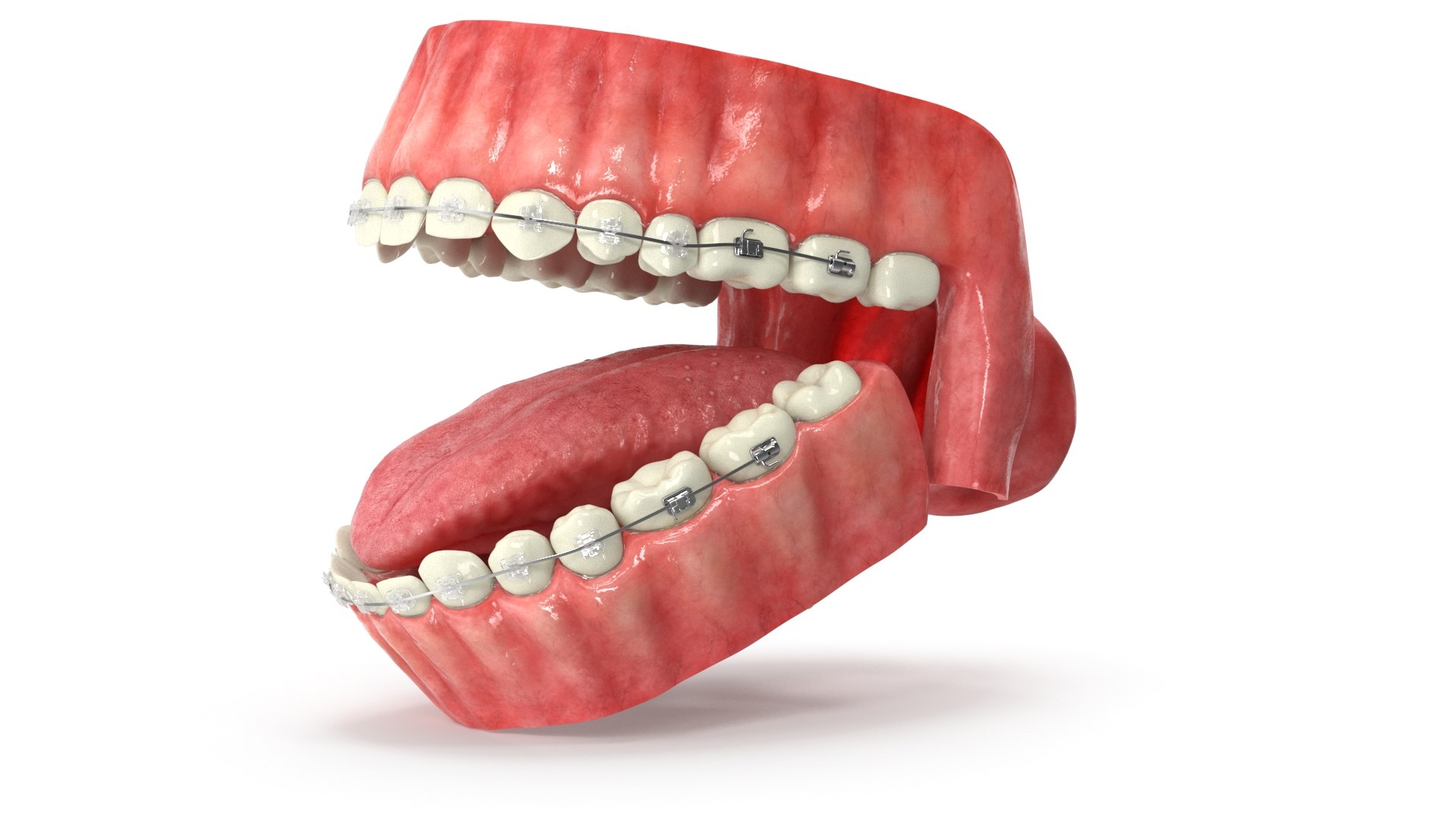 Human Mouth With Self Ligating Transparent Dental Braces V03 Model ...