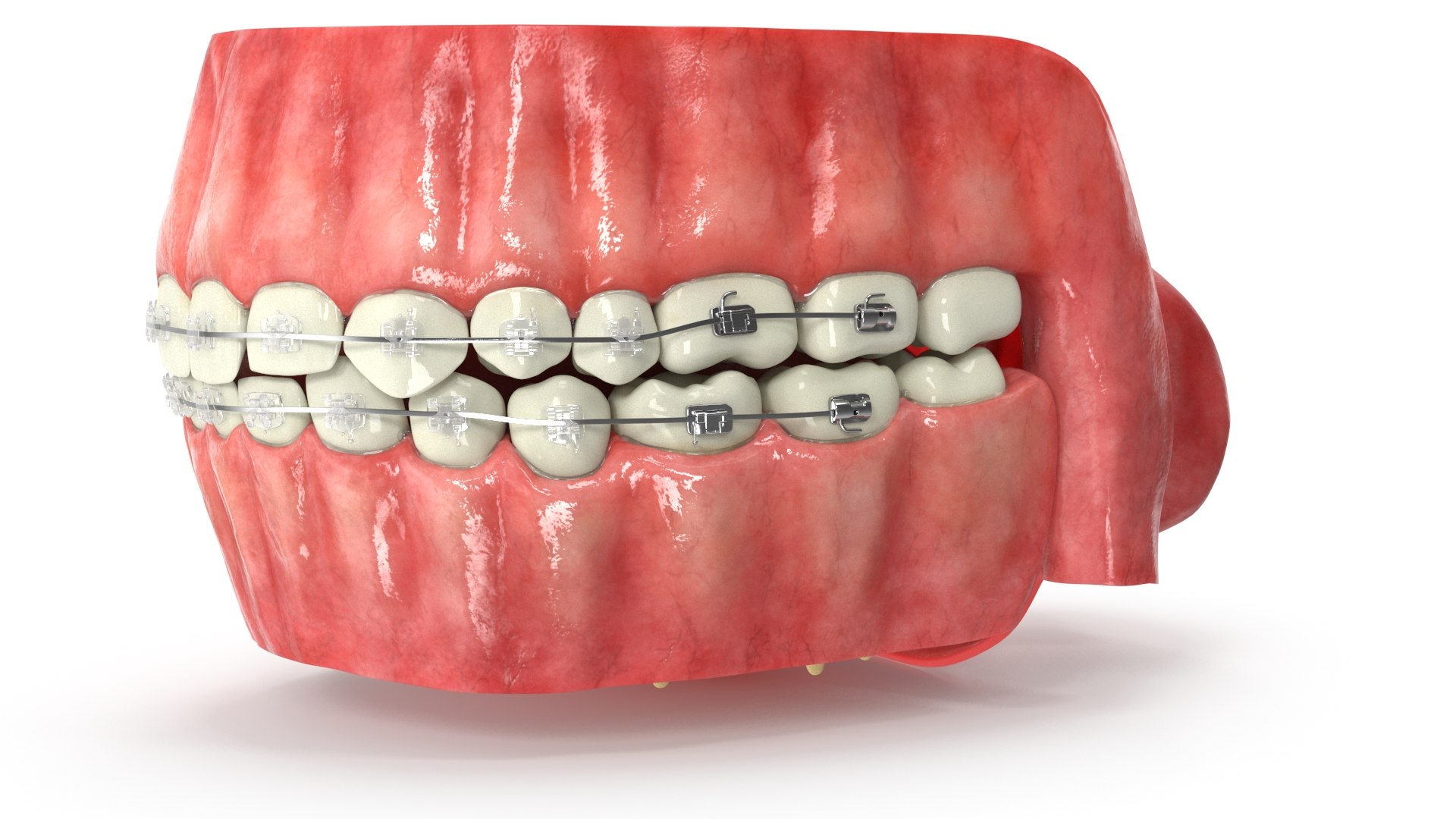 Human Mouth With Self Ligating Transparent Dental Braces V03 Model ...