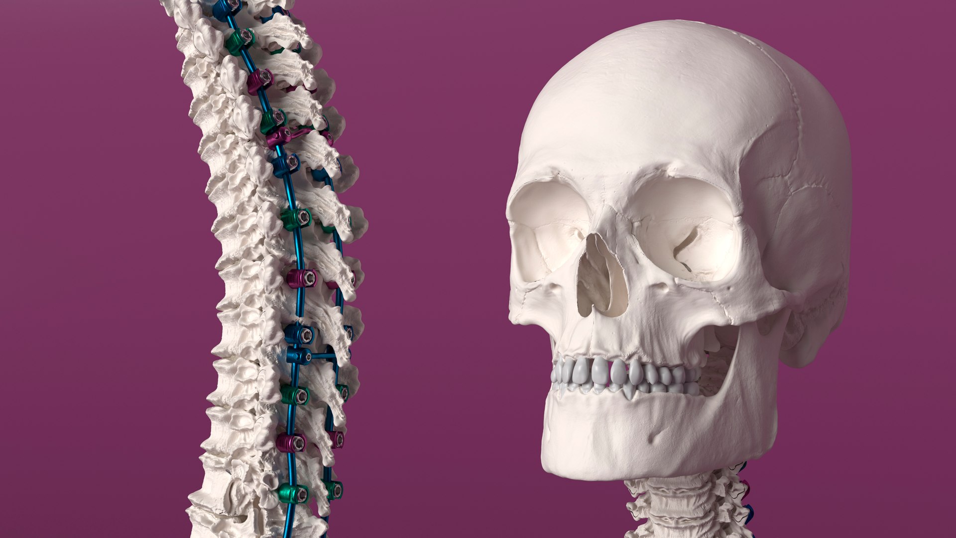 3D Bone Skull And Cervical Spine Fixation Colored Model - TurboSquid ...