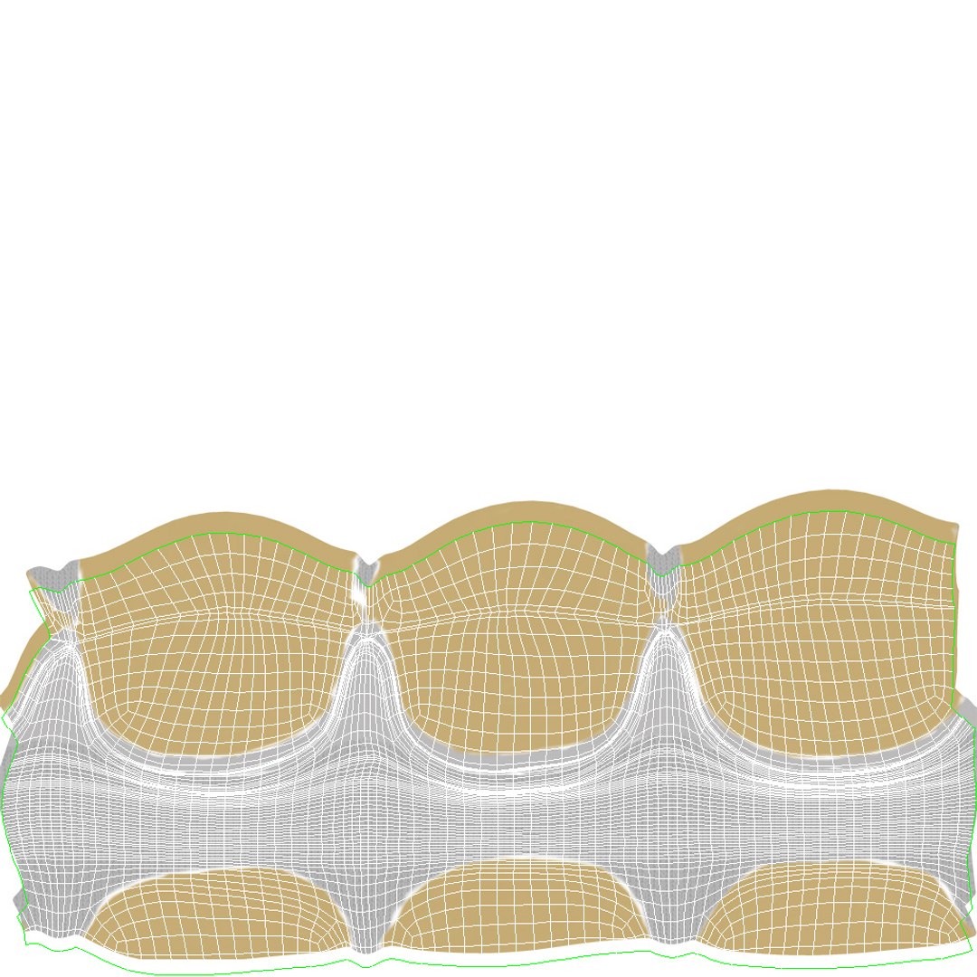 3D Stented Heart Valve - TurboSquid 1965639