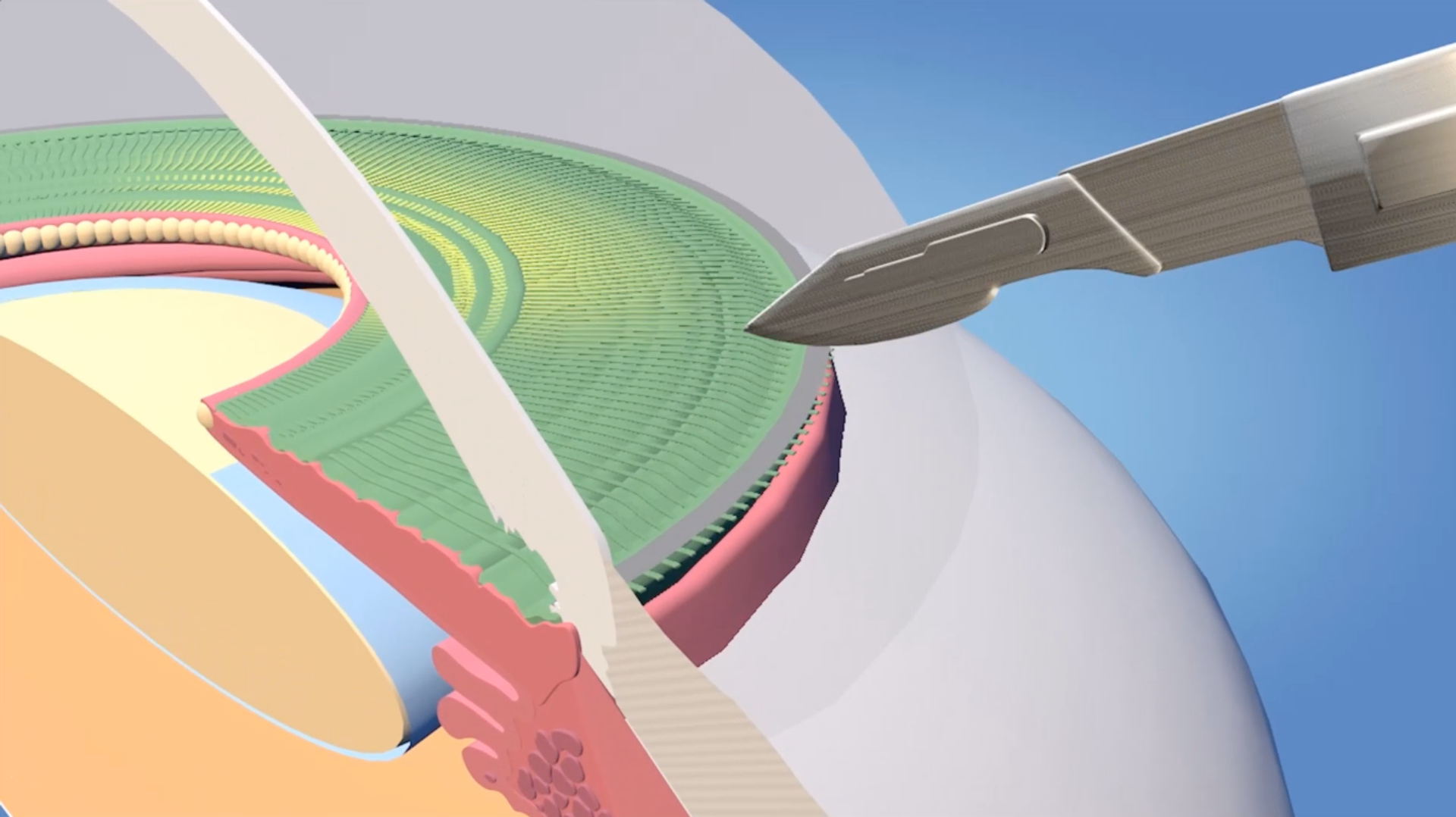 Eye cataract surgery scalpel 3D model - TurboSquid 1196453