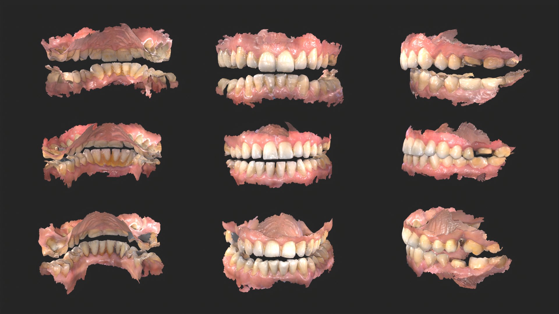 3D Dental Anatomy 3 Real Medical Cases Upper And Lower Jaw 3D Print ...