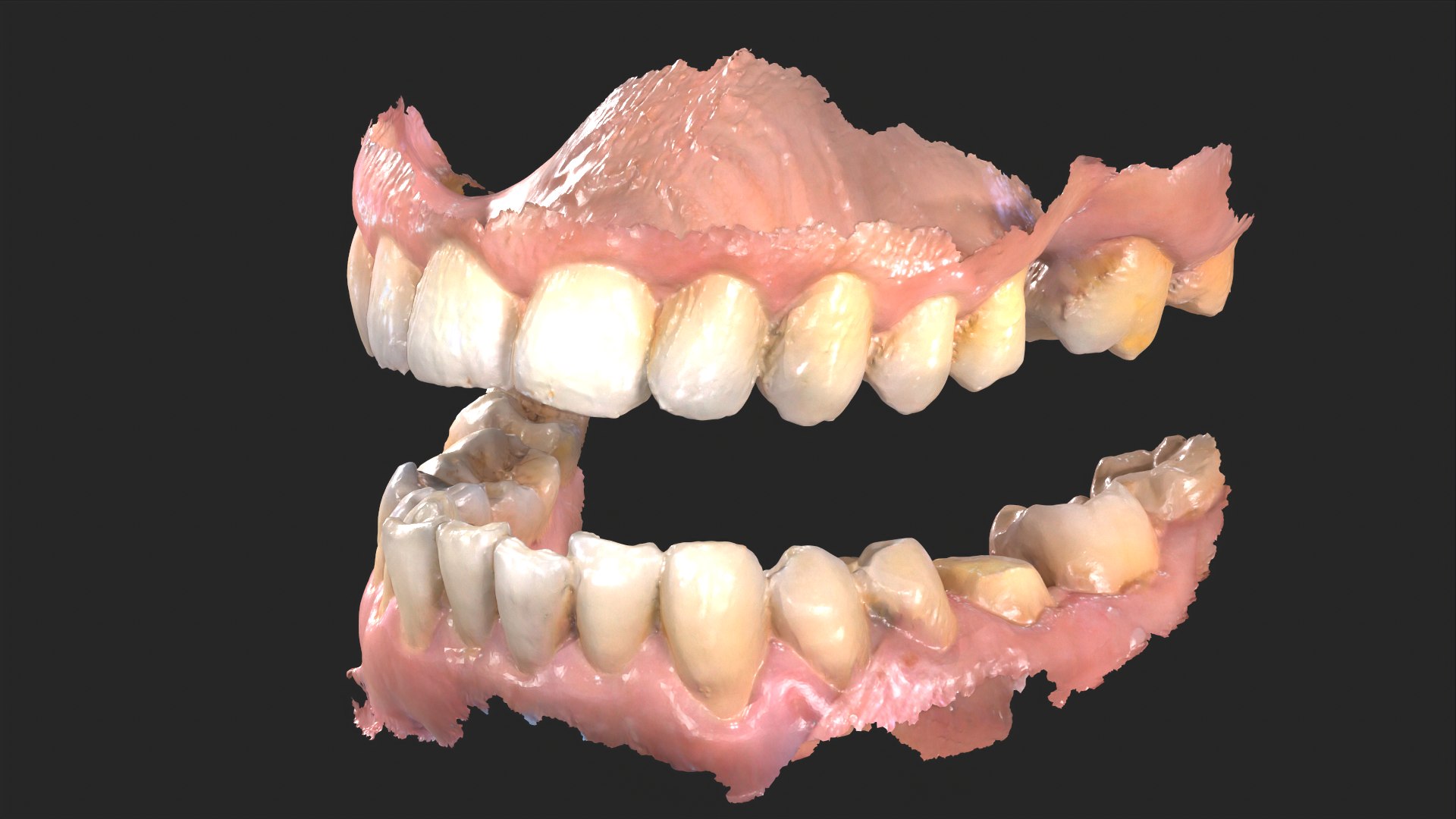 3D Dental Anatomy 3 Real Medical Cases Upper And Lower Jaw 3D Print ...