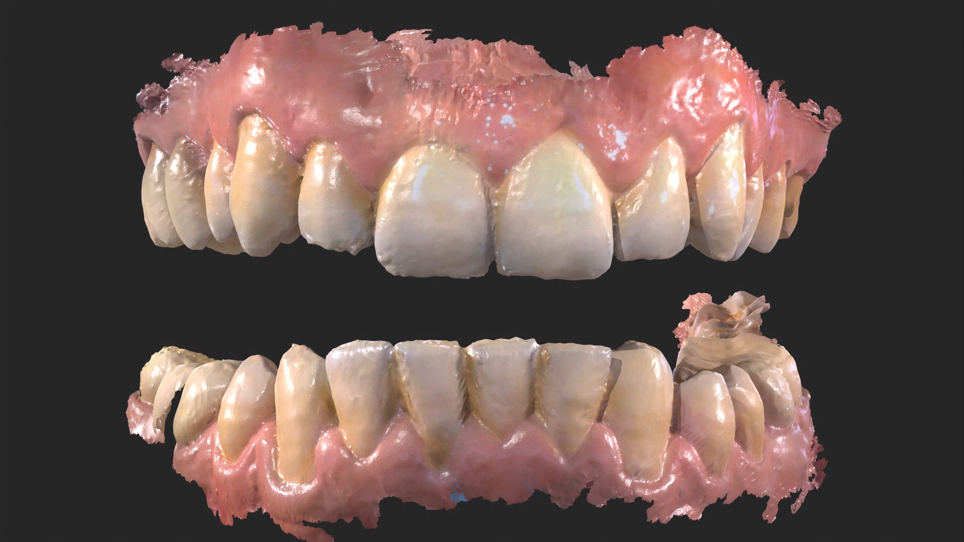 3D Dental Anatomy 3 Real Medical Cases Upper And Lower Jaw 3D Print ...