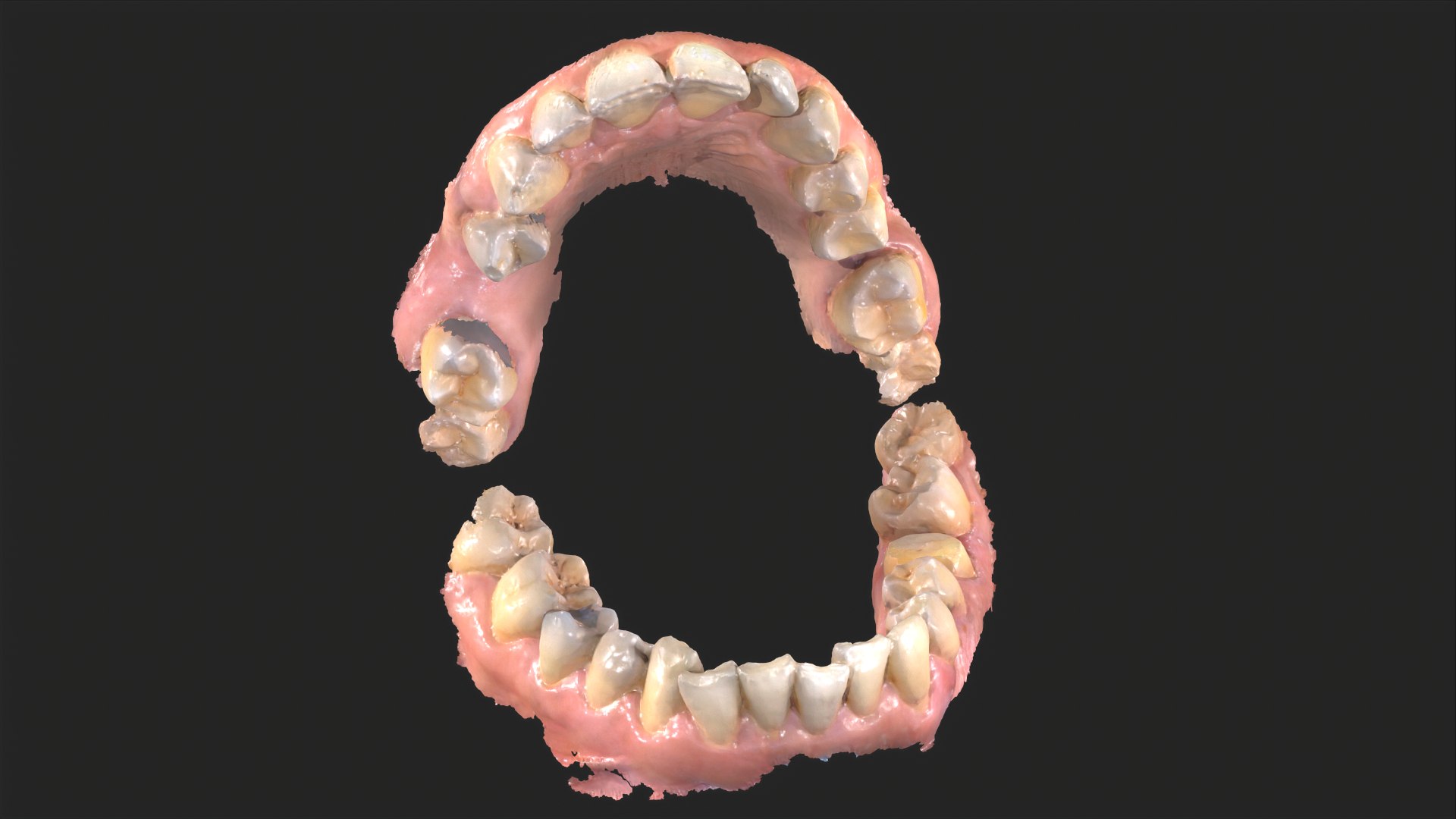 3D Dental Anatomy 3 Real Medical Cases Upper And Lower Jaw 3D Print ...