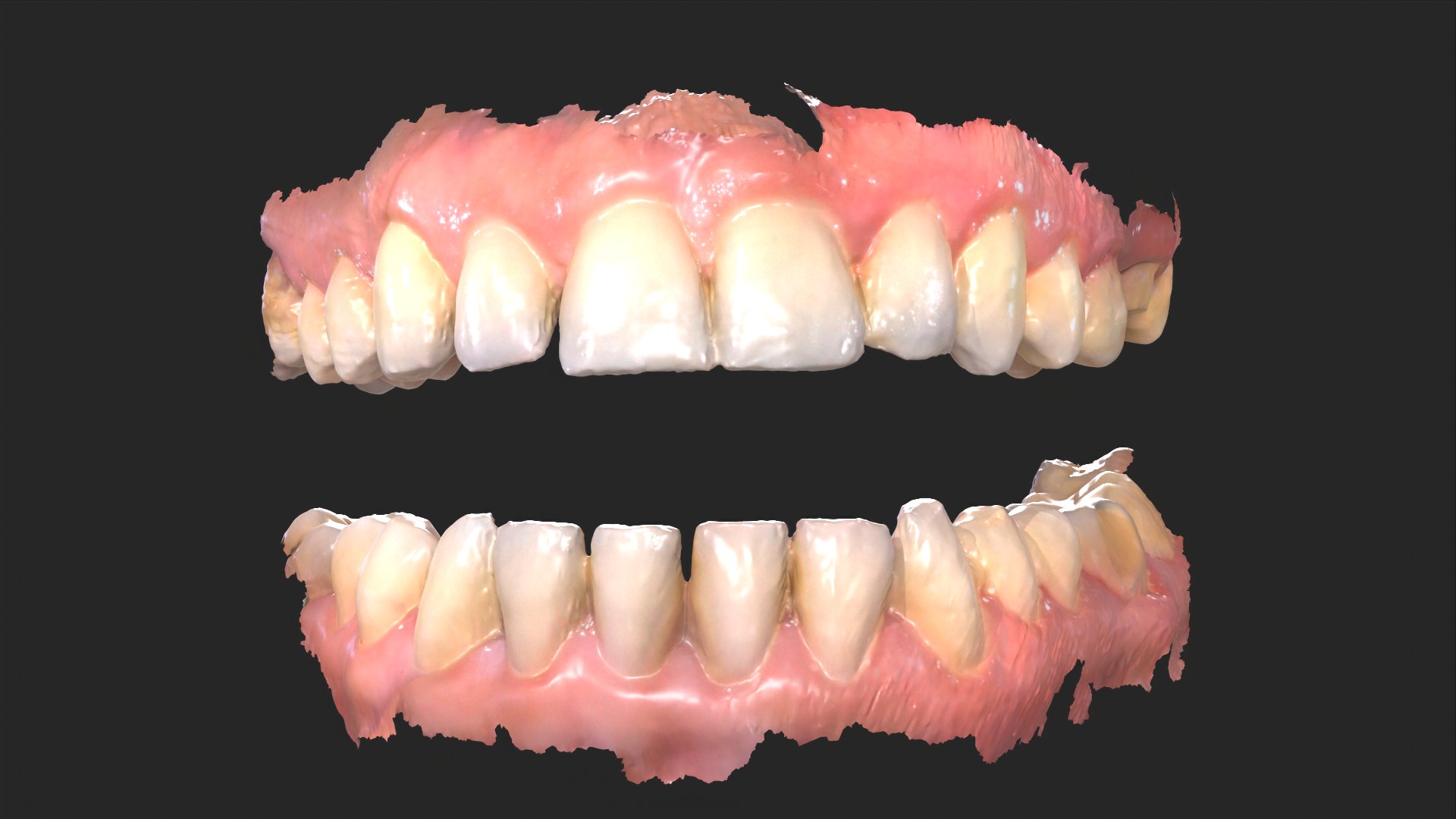 3D Dental Anatomy 3 Real Medical Cases Upper And Lower Jaw 3D Print ...
