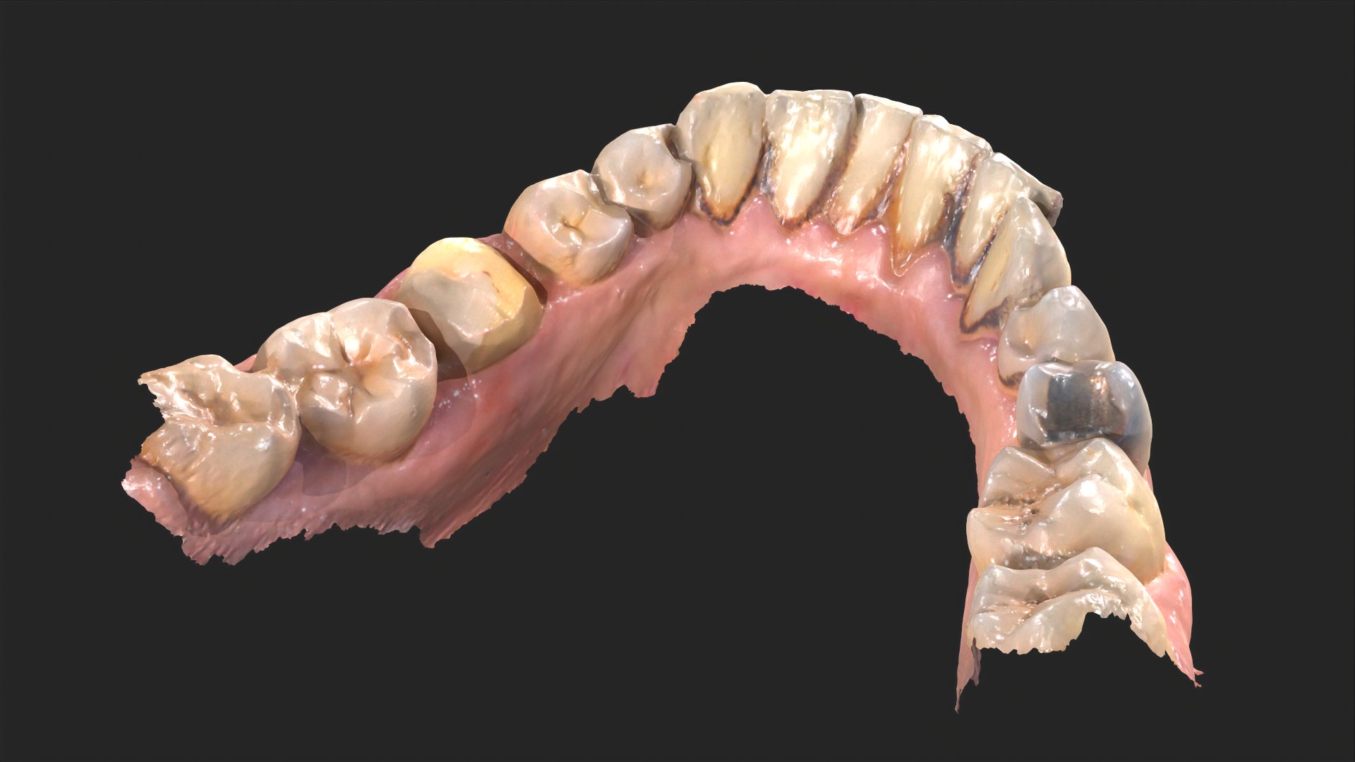 3D Dental Anatomy 3 Real Medical Cases Upper And Lower Jaw 3D Print ...