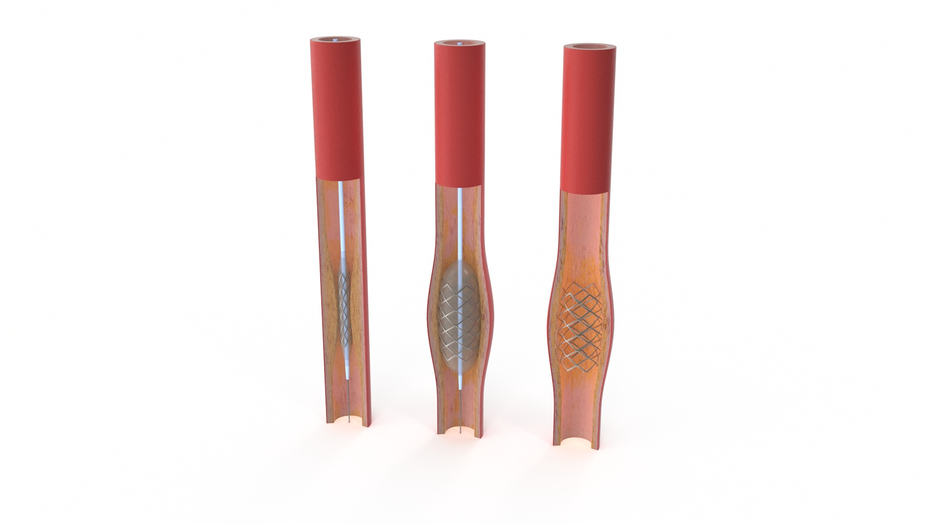 Stents With Artery 3D Model - TurboSquid 2239816
