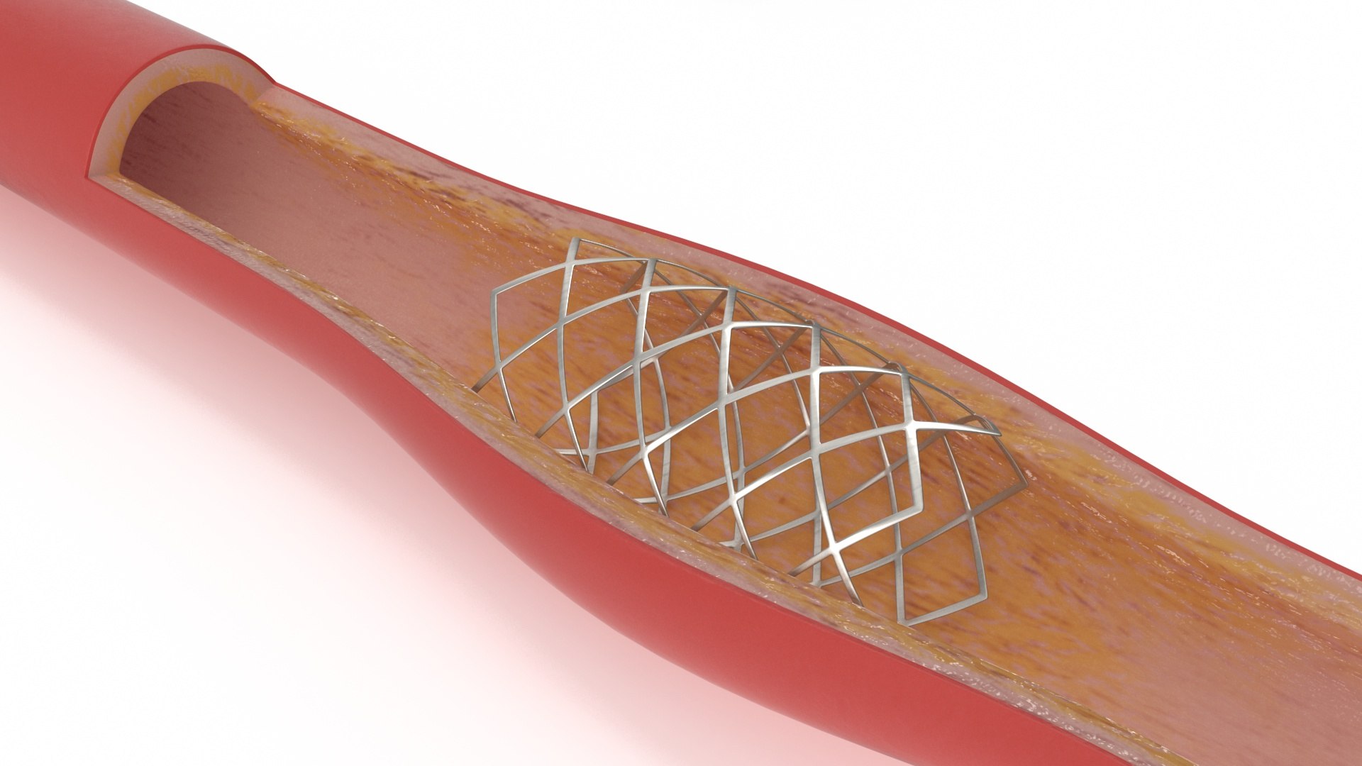 Stents With Artery 3D Model - TurboSquid 2239816