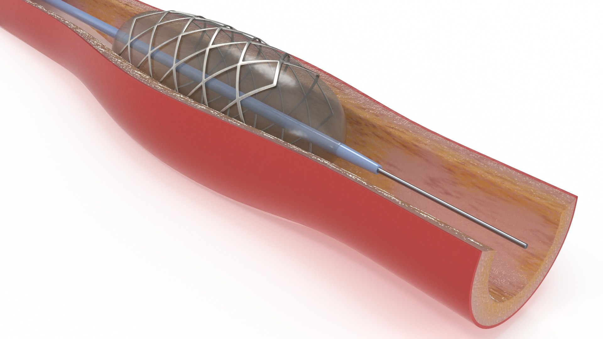 Stents With Artery 3D Model - TurboSquid 2239816