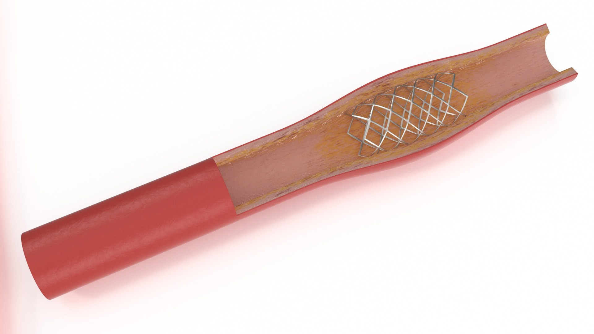 Stents With Artery 3D Model - TurboSquid 2239816