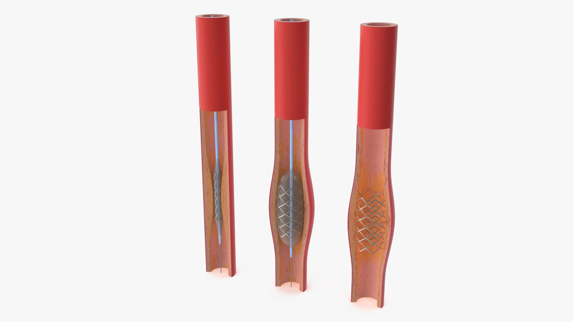 Stents With Artery 3D Model - TurboSquid 2239816