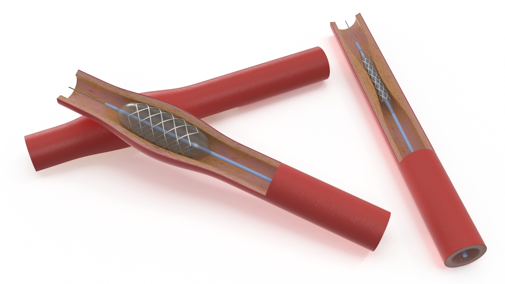 Stents With Artery 3D Model - TurboSquid 2239816