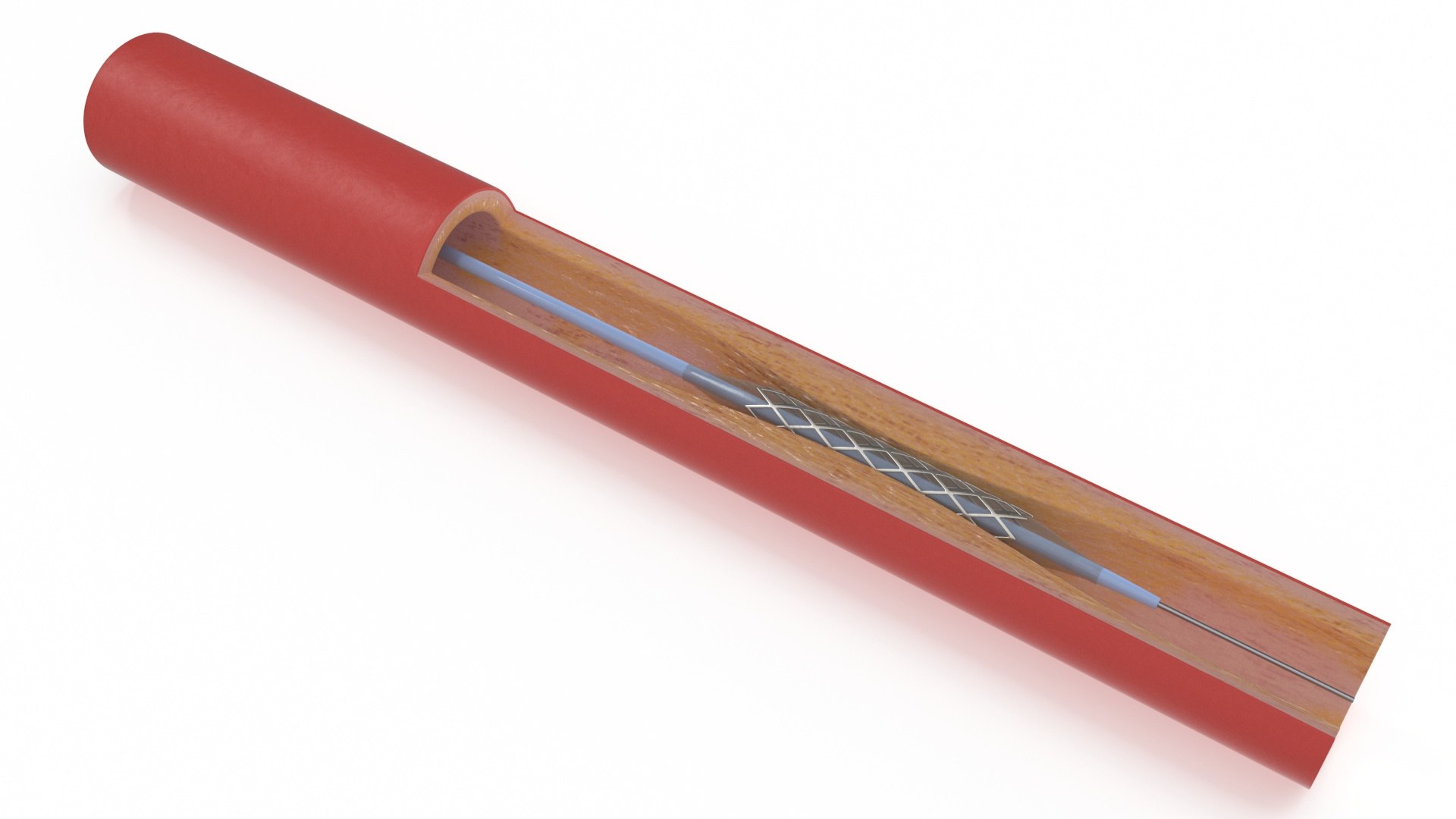 Stents With Artery 3D Model - TurboSquid 2239816