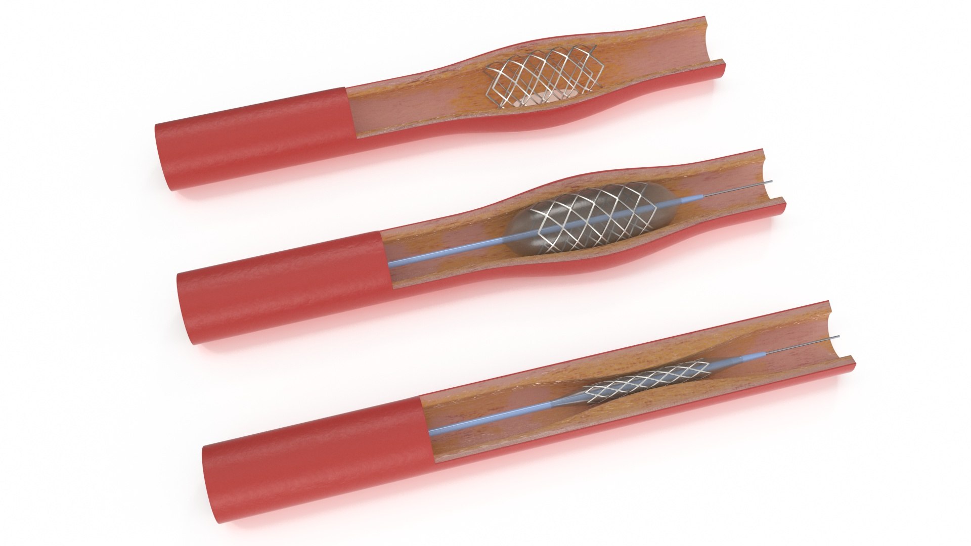Stents With Artery 3D Model - TurboSquid 2239816