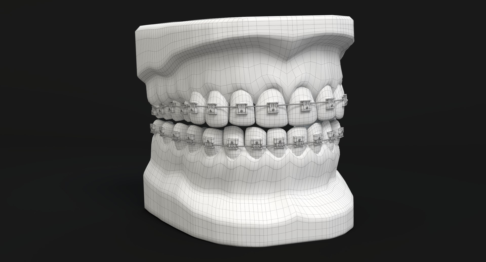 3D Mouth Braces Modeled Model - TurboSquid 1250915