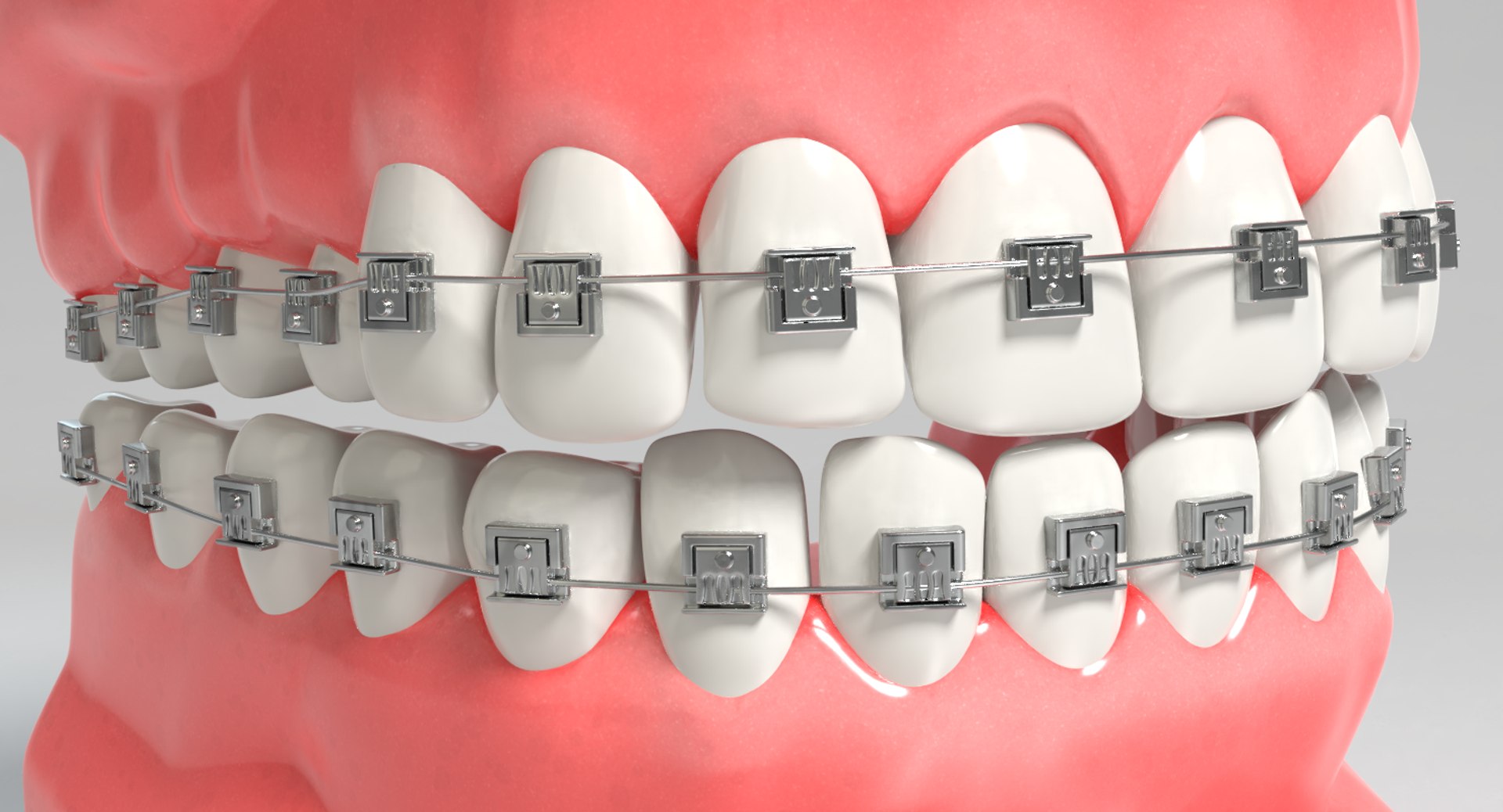 3D Mouth Braces Modeled Model - TurboSquid 1250915