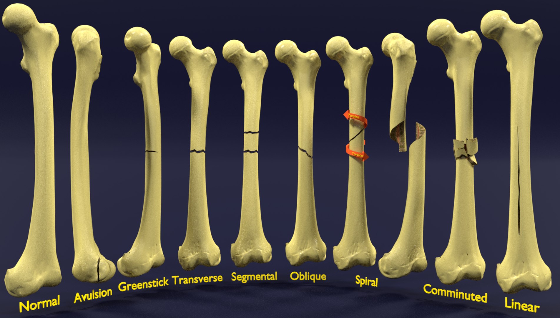 3D Model Types Fractures - TurboSquid 1480748