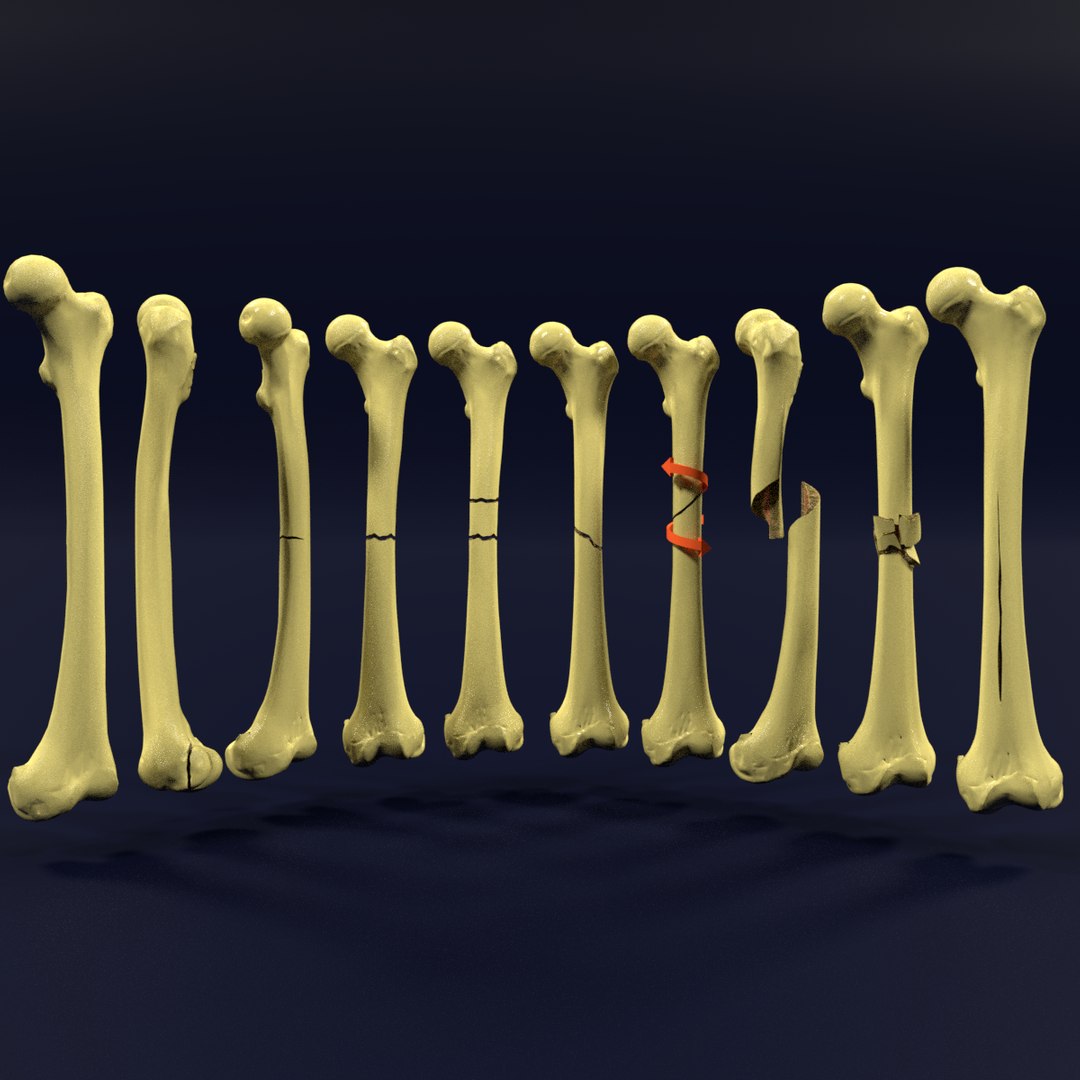 3D Model Types Fractures - TurboSquid 1480748