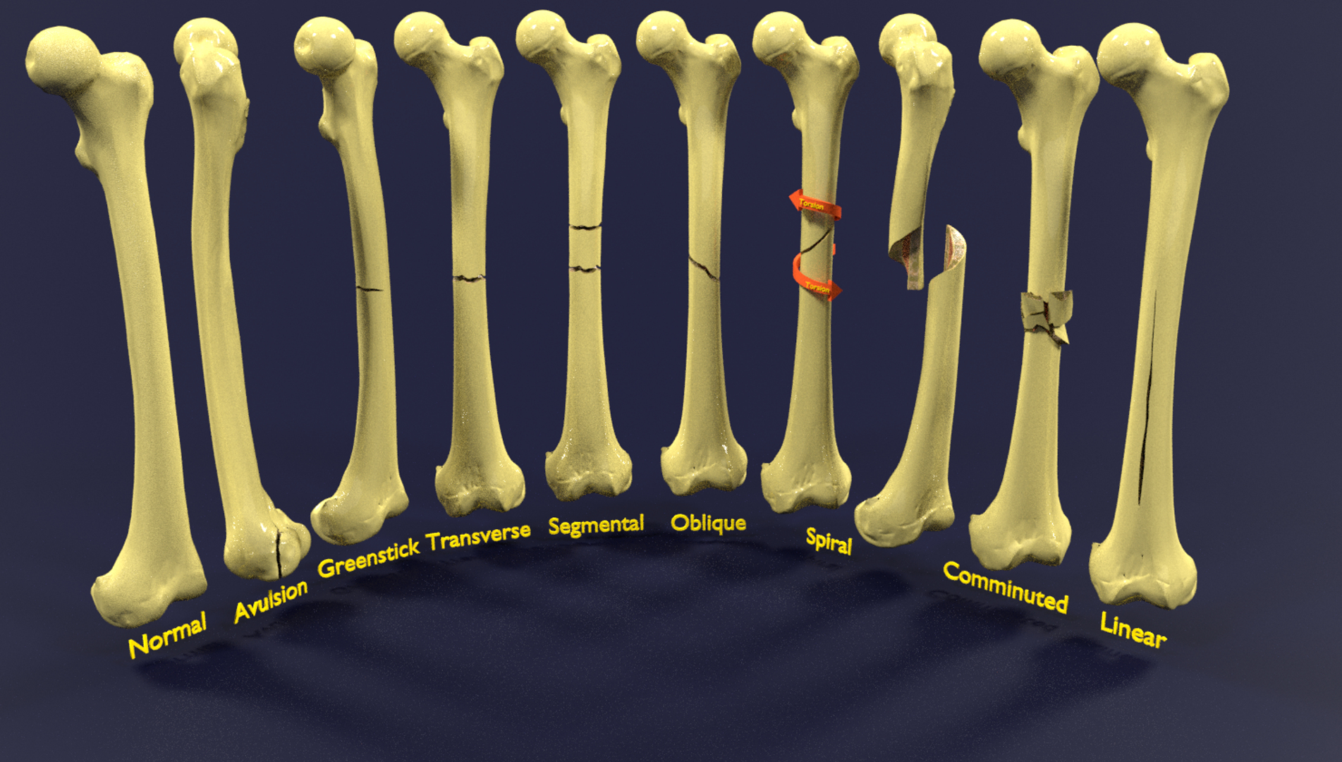 3D Model Types Fractures - TurboSquid 1480748