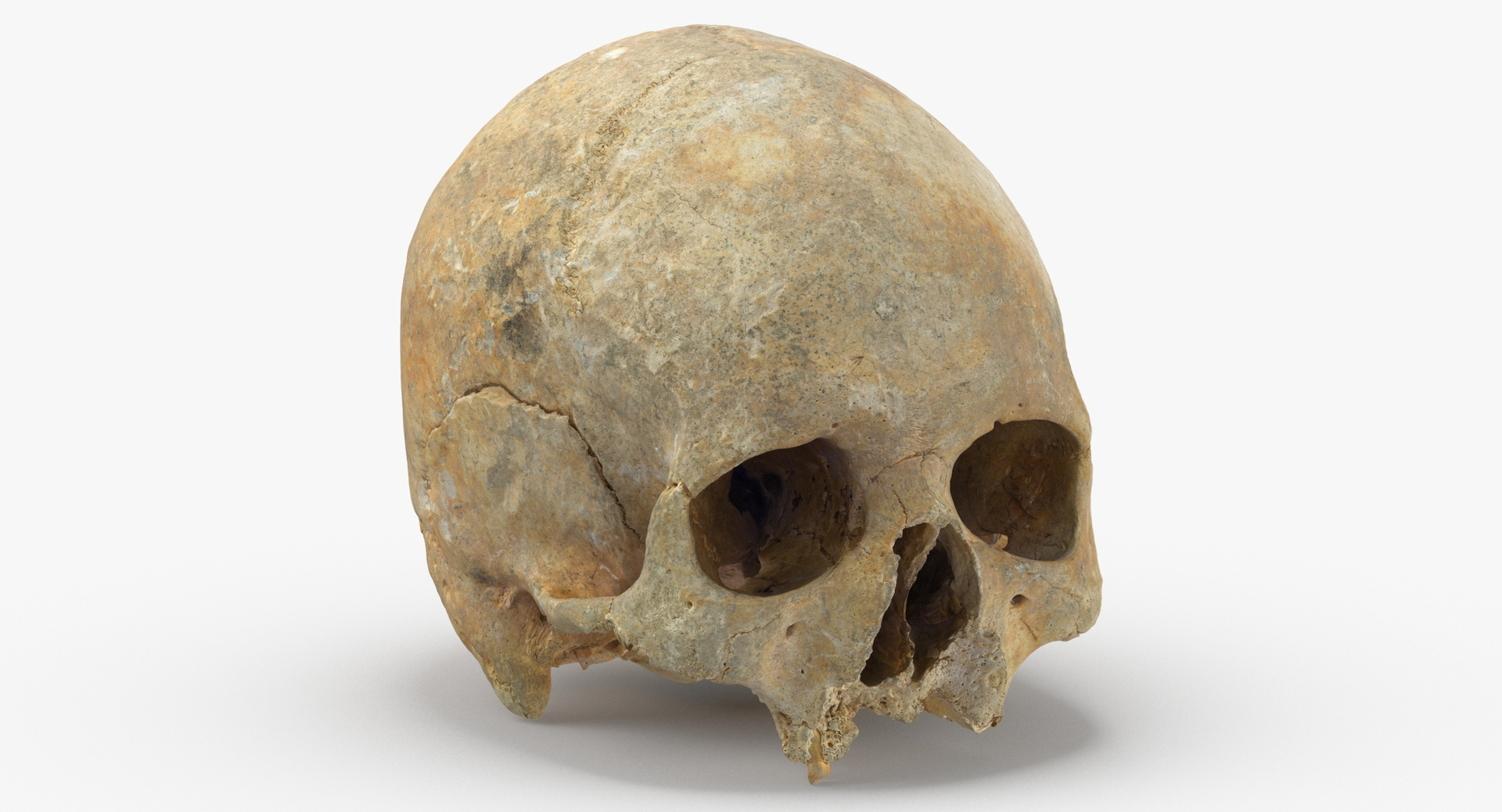 Human Skull Cranium Leprosy 3D Model - TurboSquid 1537597