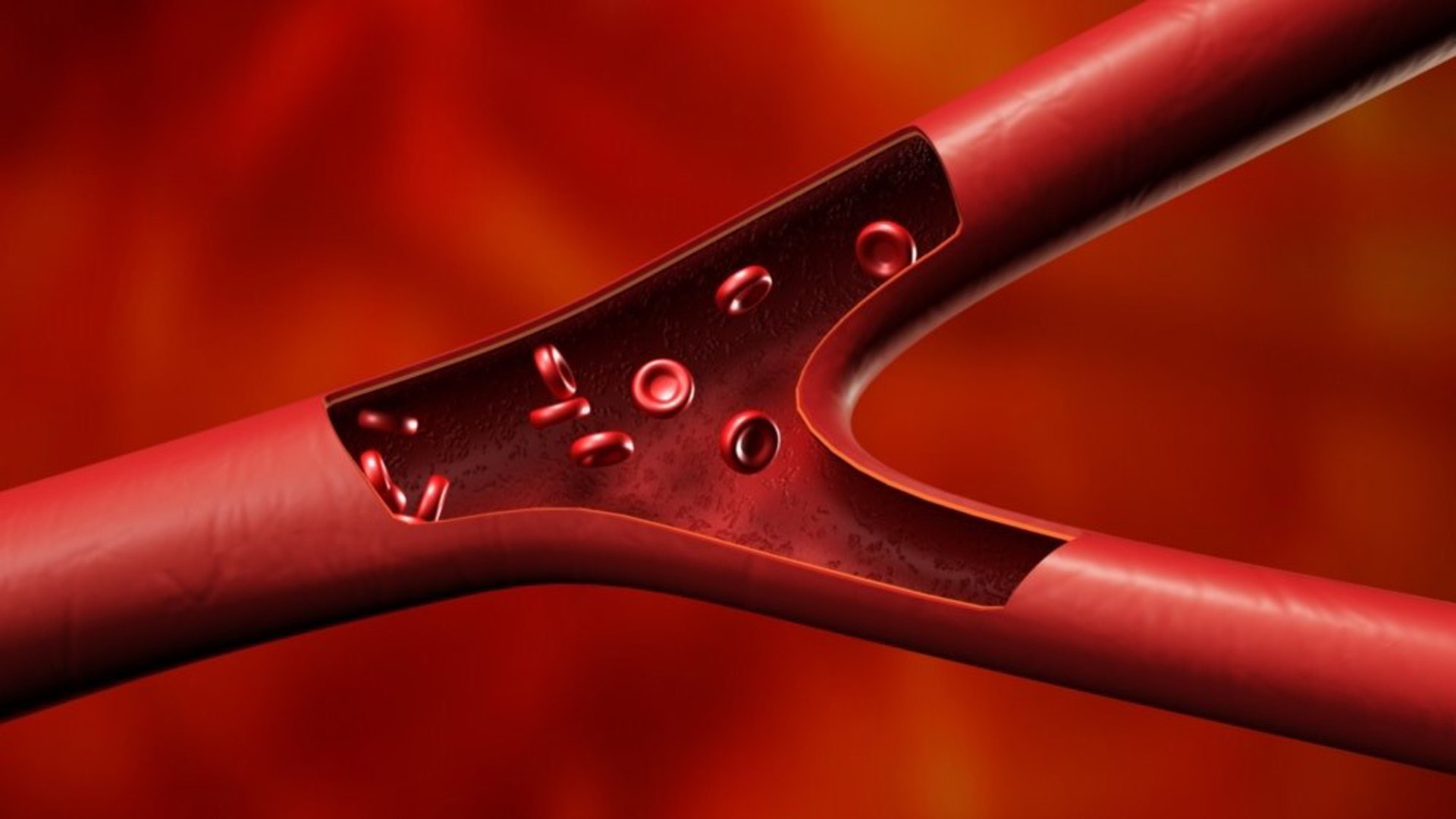 Artery Vein Clog Clot Clogged Stream Bloodflow Layers Section Anatomy ...