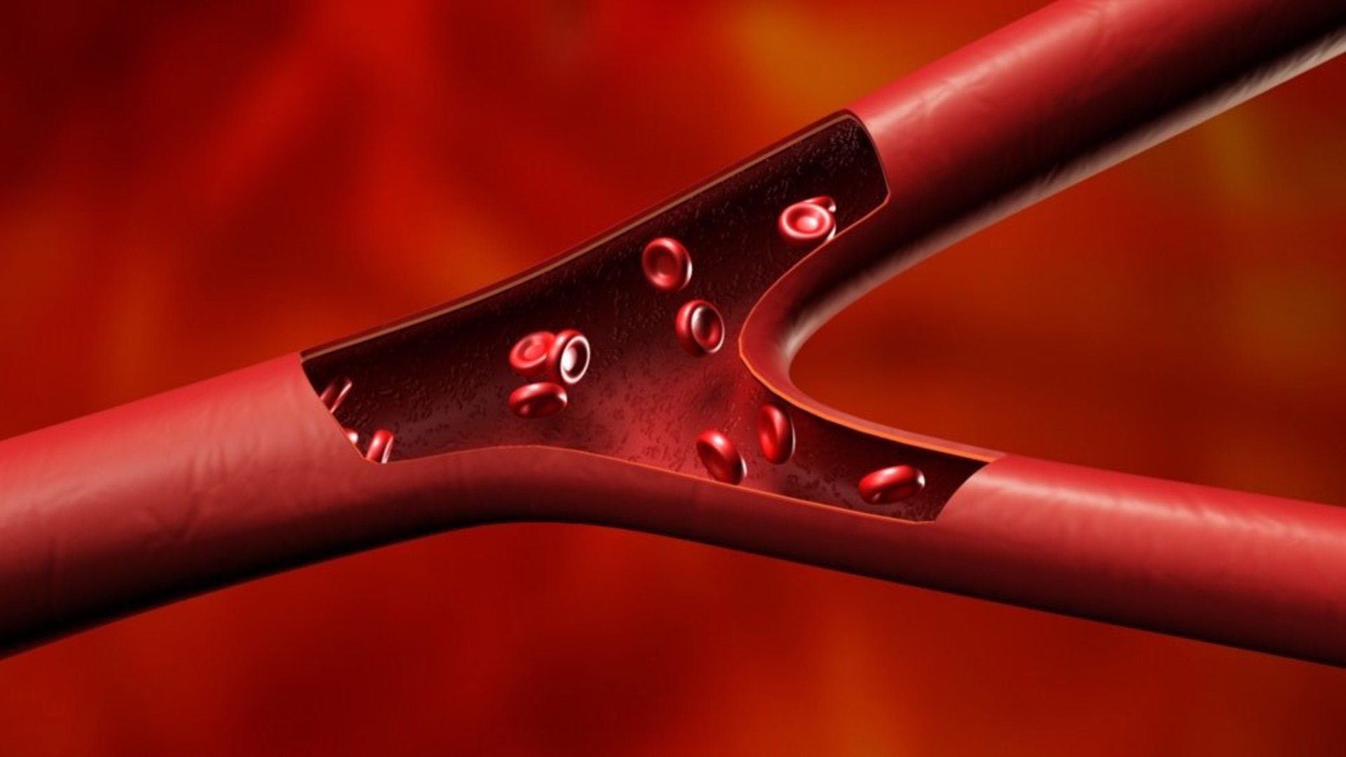 Artery Vein Clog Clot Clogged Stream Bloodflow Layers Section Anatomy ...