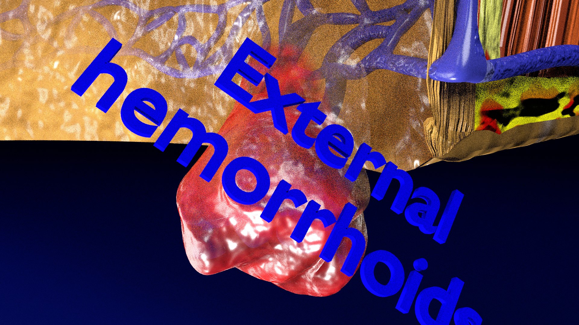 3D Hemorrhoids CLEANED UP Model - TurboSquid 1808970