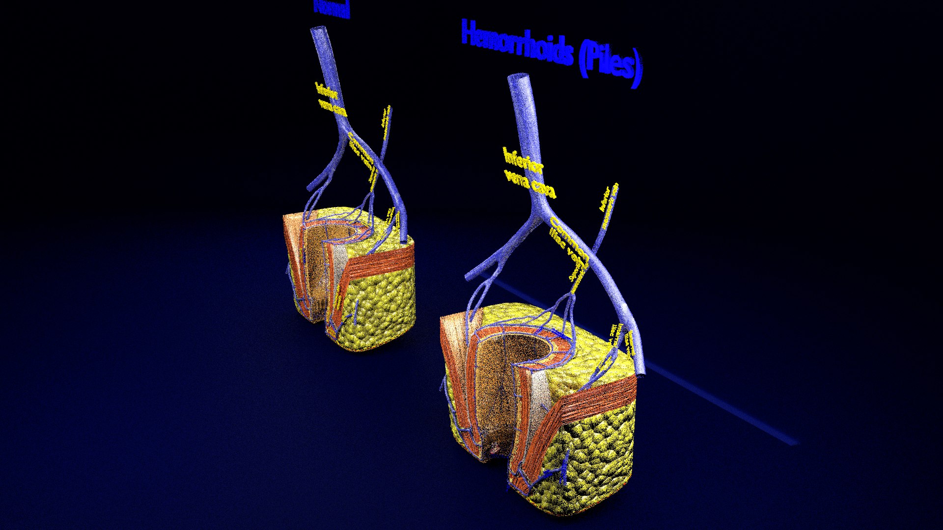 3D Hemorrhoids CLEANED UP Model - TurboSquid 1808970