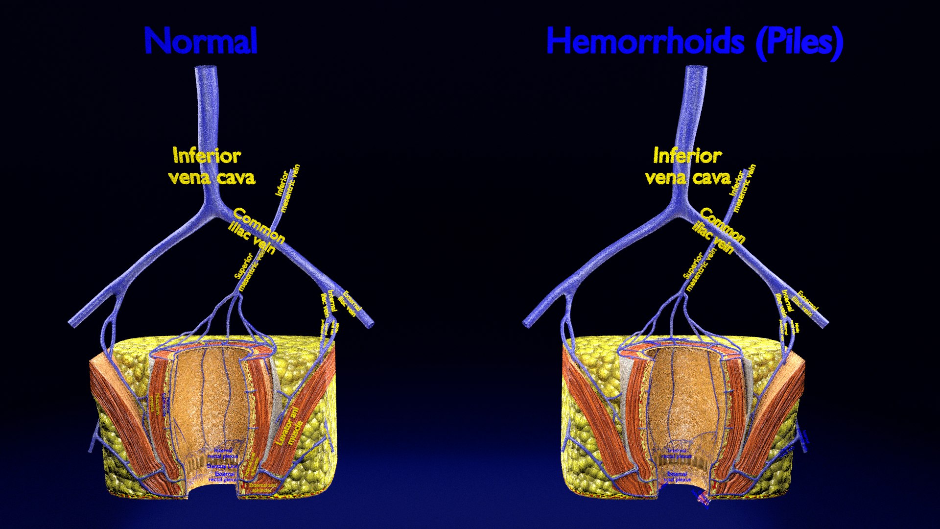 3D Hemorrhoids CLEANED UP Model - TurboSquid 1808970