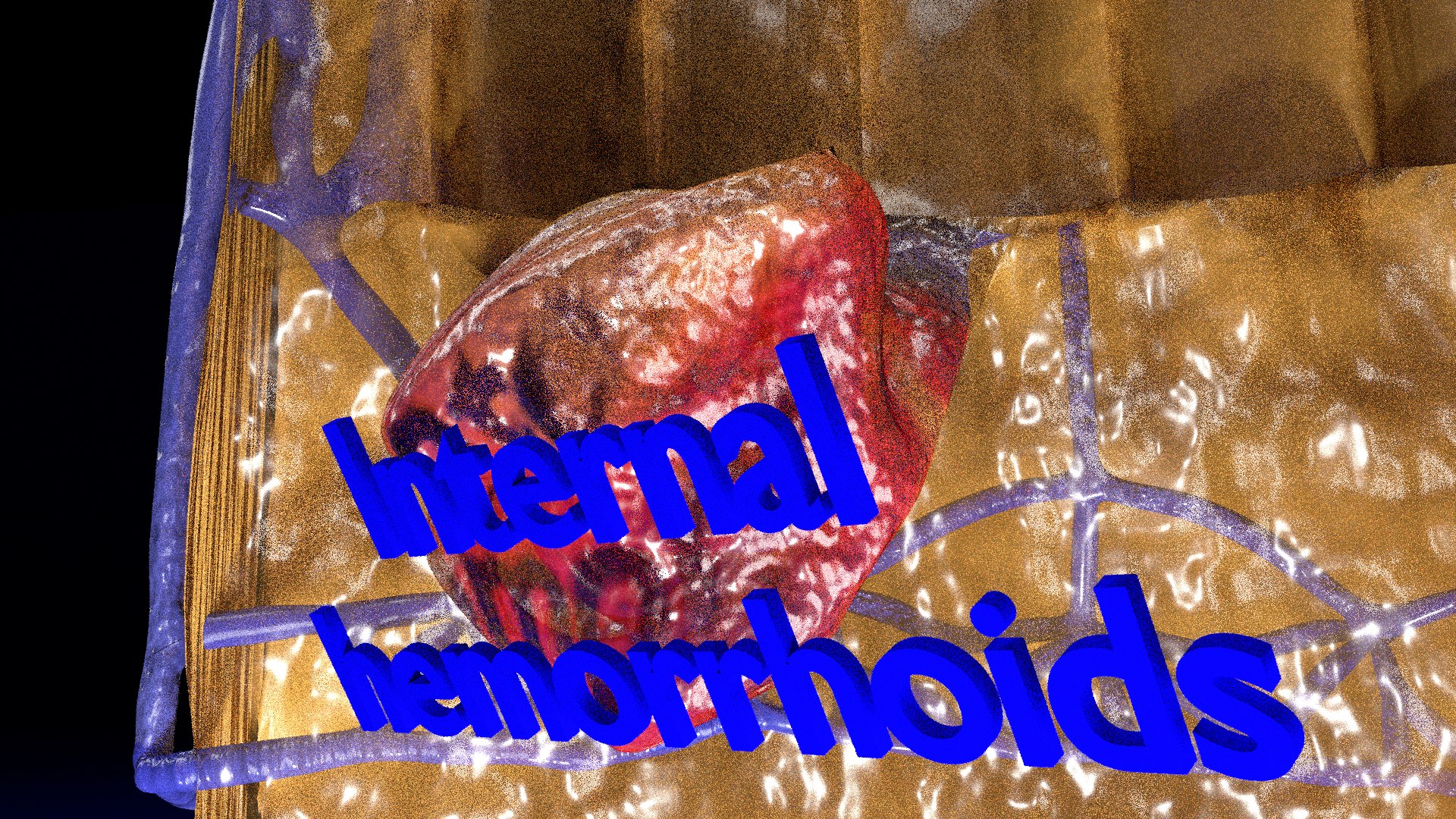3D Hemorrhoids CLEANED UP Model - TurboSquid 1808970