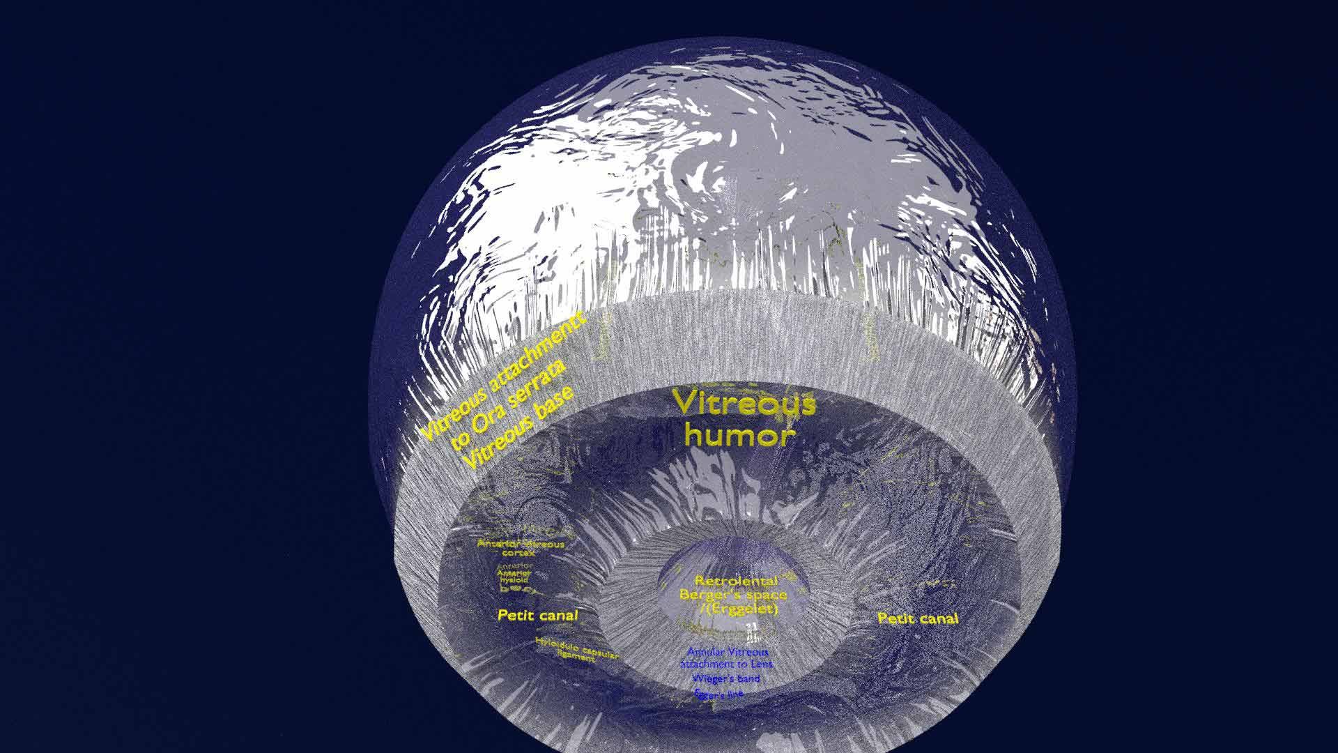 3D Model Posterior Vitreous Detachment Types Eye - TurboSquid 2031134