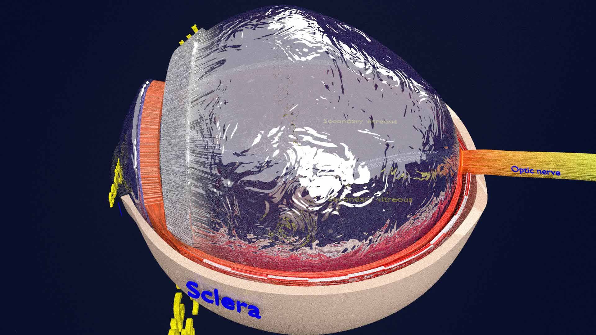 3D Model Posterior Vitreous Detachment Types Eye - TurboSquid 2031134