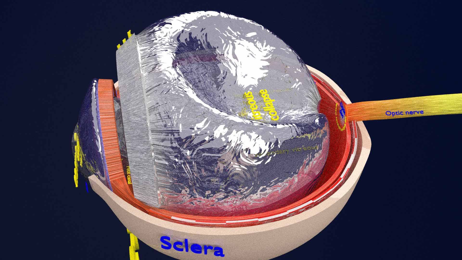 3D Model Posterior Vitreous Detachment Types Eye - TurboSquid 2031134
