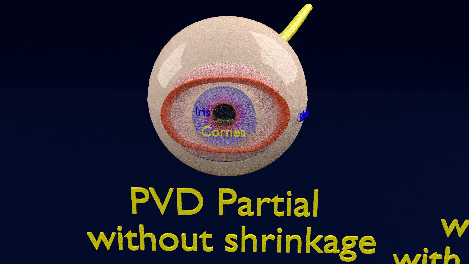 3D Model Posterior Vitreous Detachment Types Eye - TurboSquid 2031134