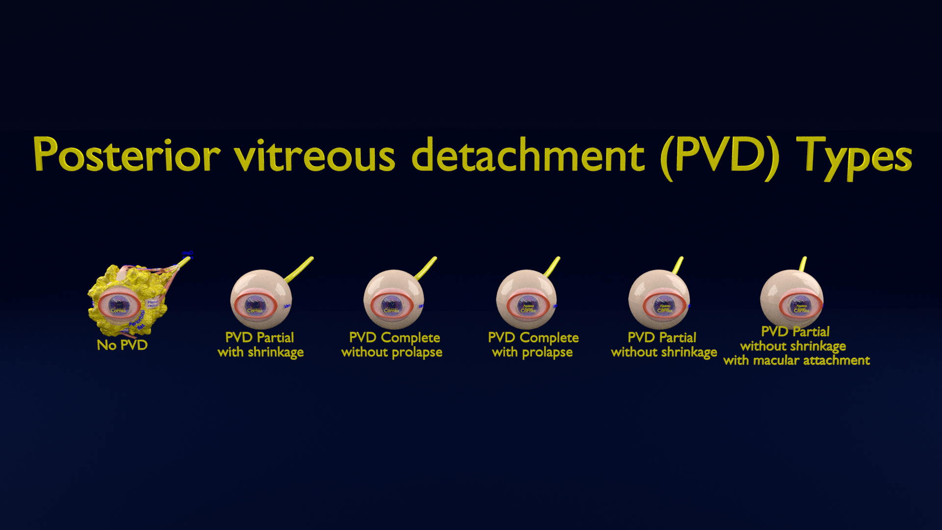 3D Model Posterior Vitreous Detachment Types Eye - TurboSquid 2031134