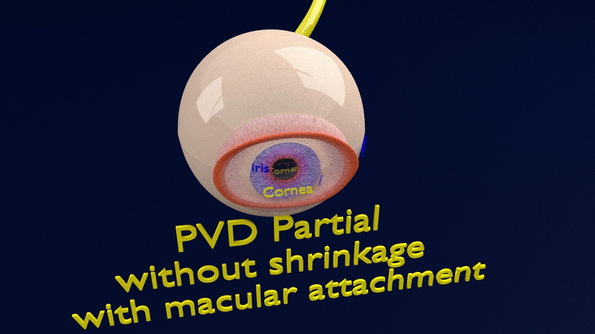 3D Model Posterior Vitreous Detachment Types Eye - TurboSquid 2031134