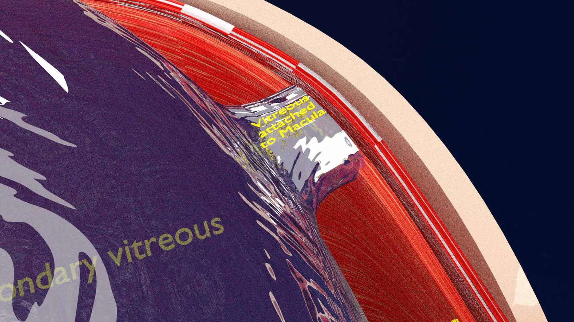 3D Model Posterior Vitreous Detachment Types Eye - TurboSquid 2031134