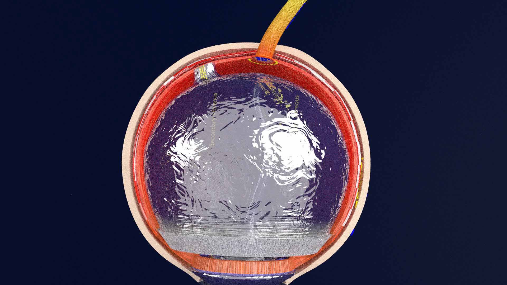 3D Model Posterior Vitreous Detachment Types Eye - TurboSquid 2031134