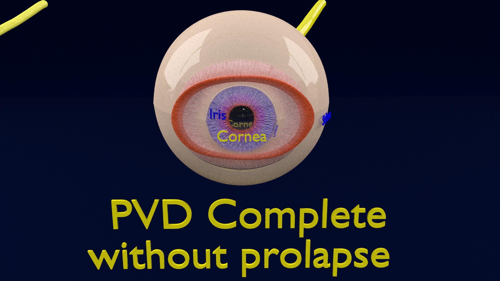 3D Model Posterior Vitreous Detachment Types Eye - TurboSquid 2031134