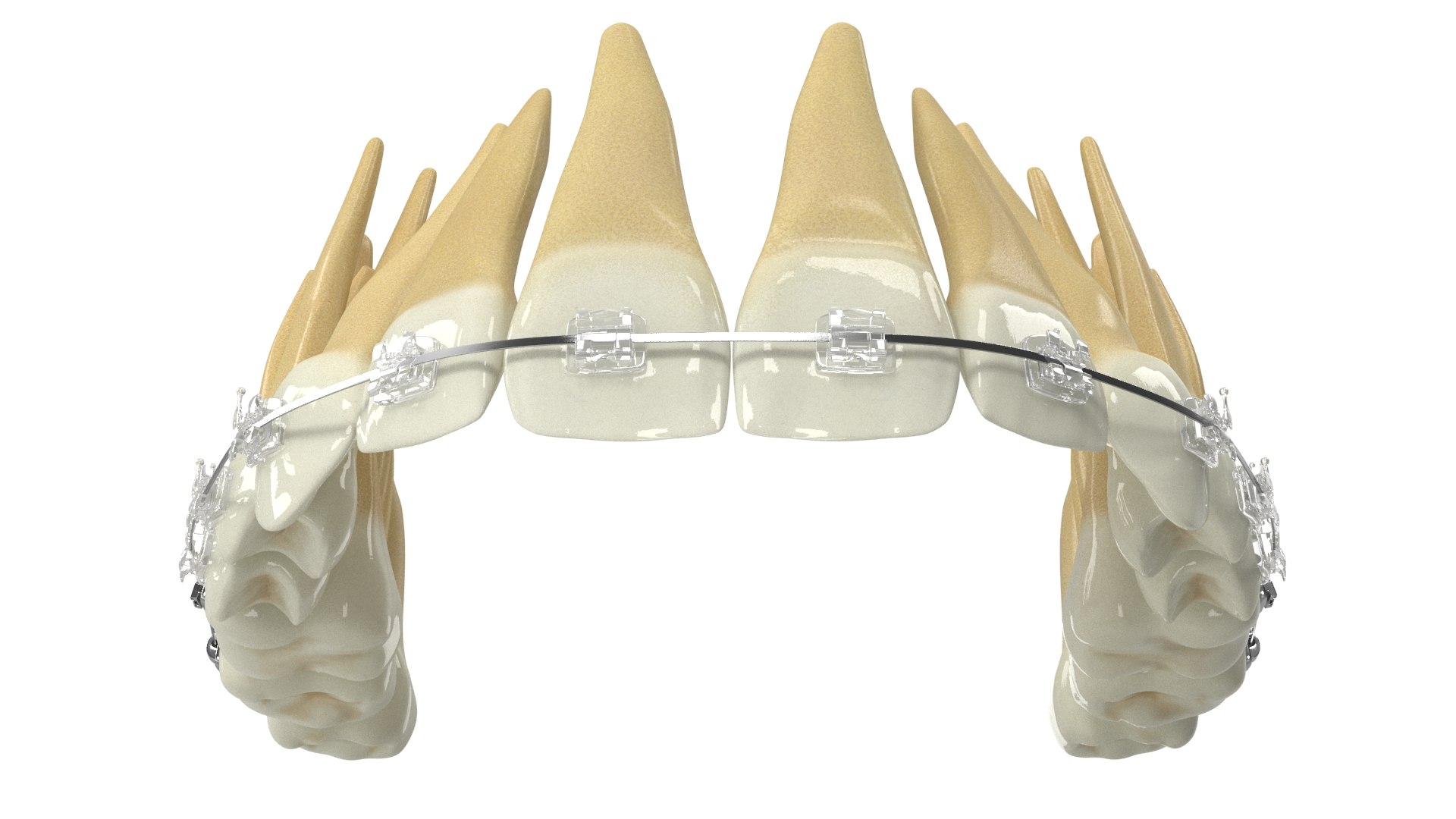 3D Human Teeth With Self Ligating Transparent Dental Braces V03 ...