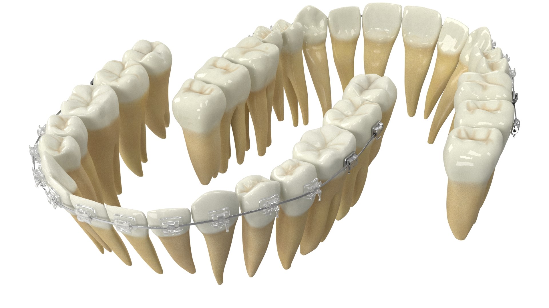 3D Human Teeth With Self Ligating Transparent Dental Braces V03 ...