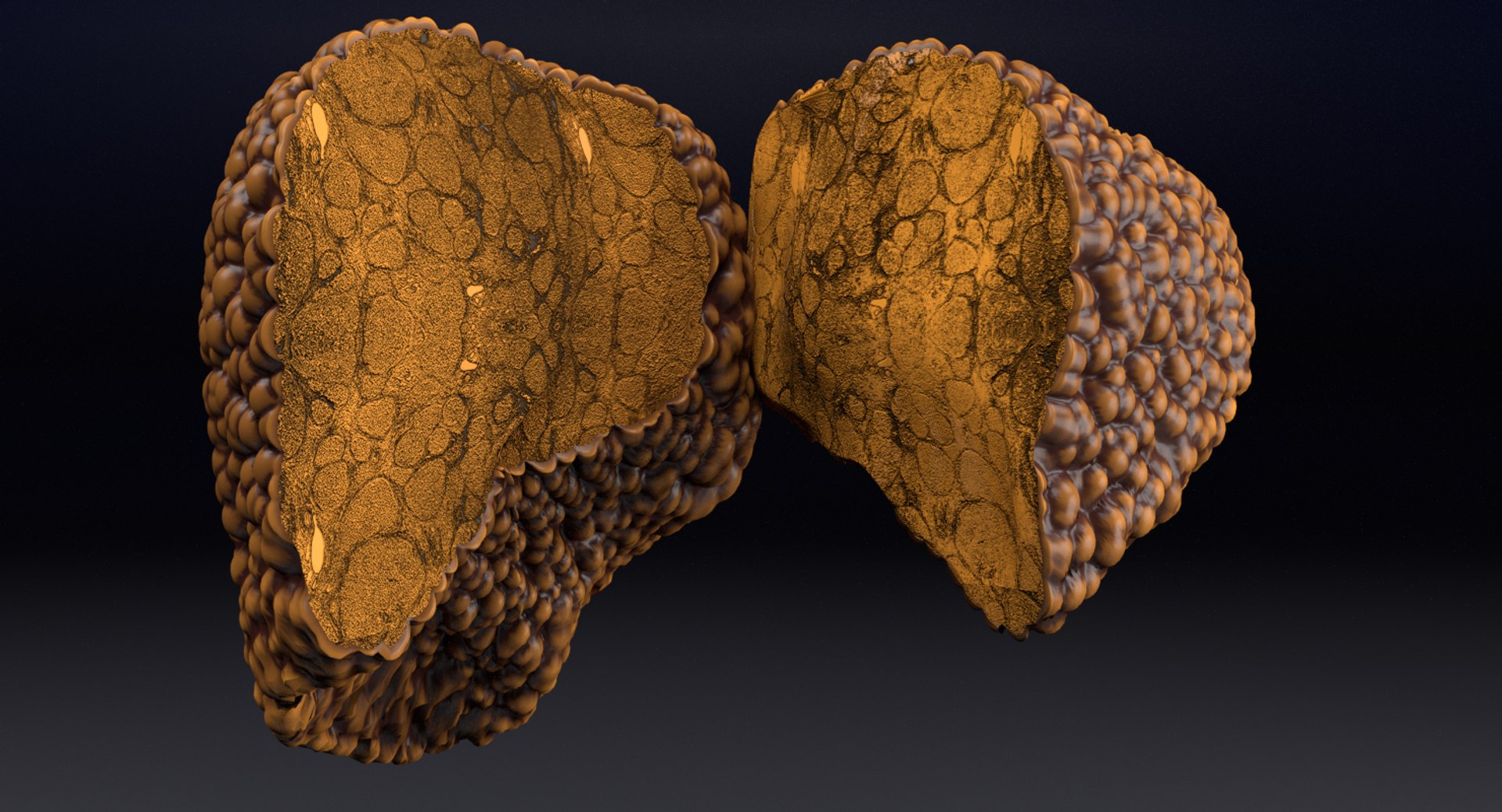 3D alcoholic liver disease fatty model - TurboSquid 1382254